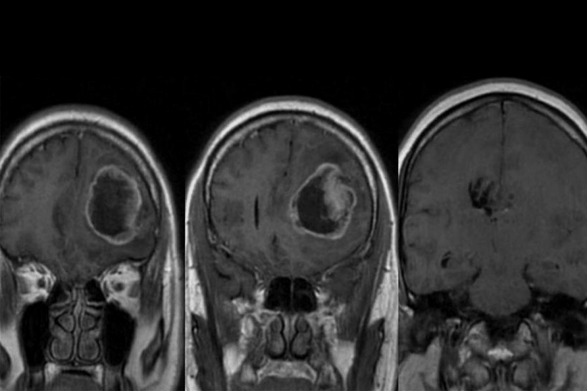 When to worry about MRI results? Understanding MRI Timing and ...