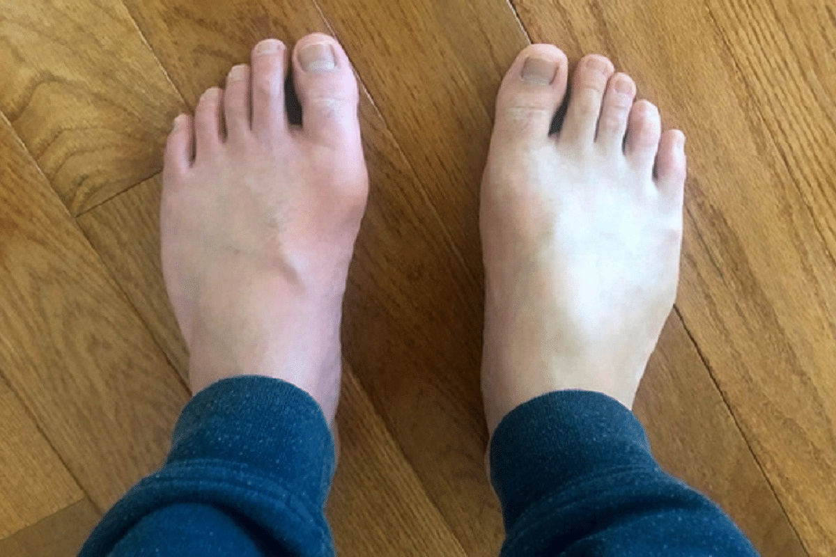 Simple What Is CPPD: Calcium Pyrophosphate Crystals Explained - Liv ...