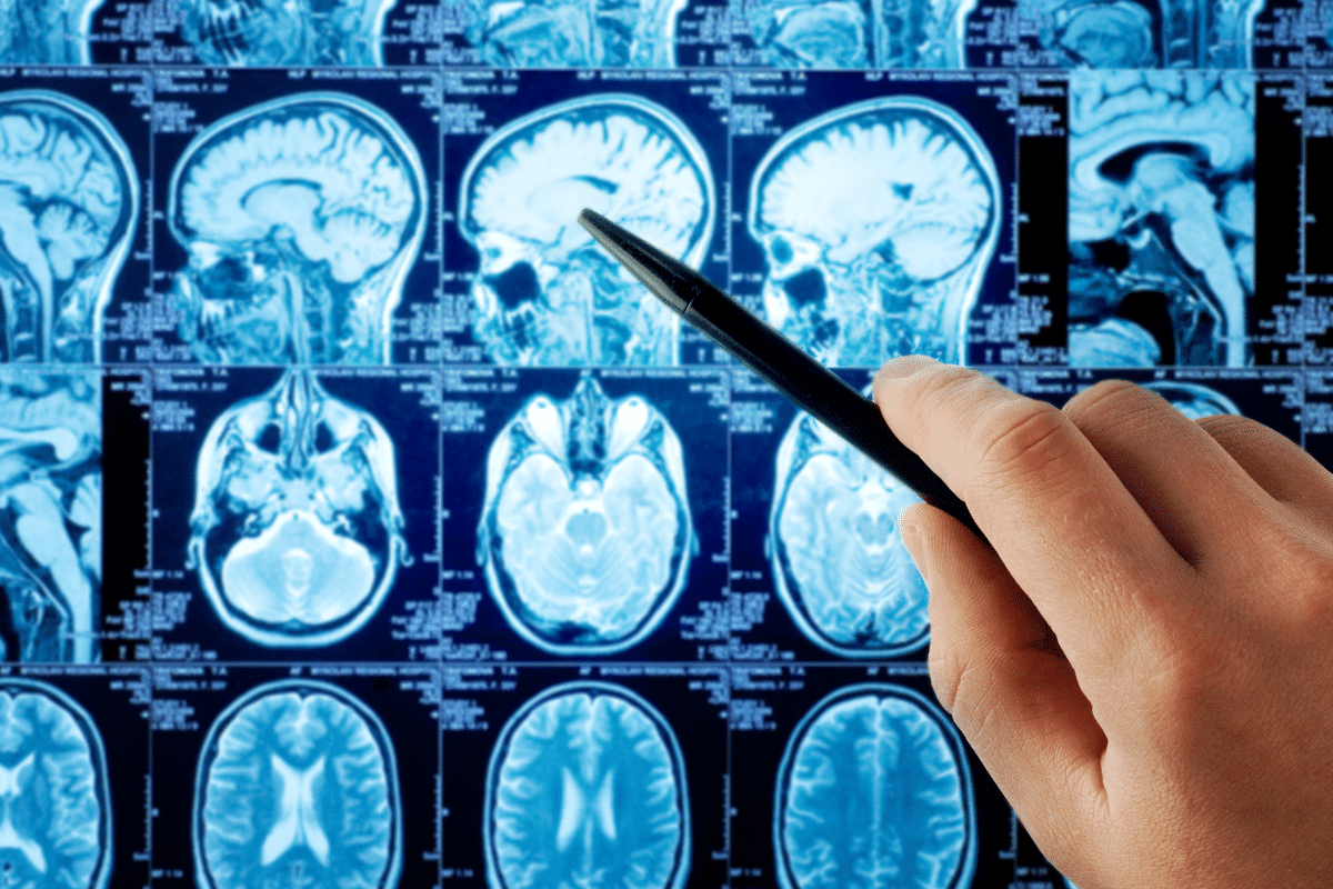 Amnesia Definition: The Essential Meaning - Liv Hospital