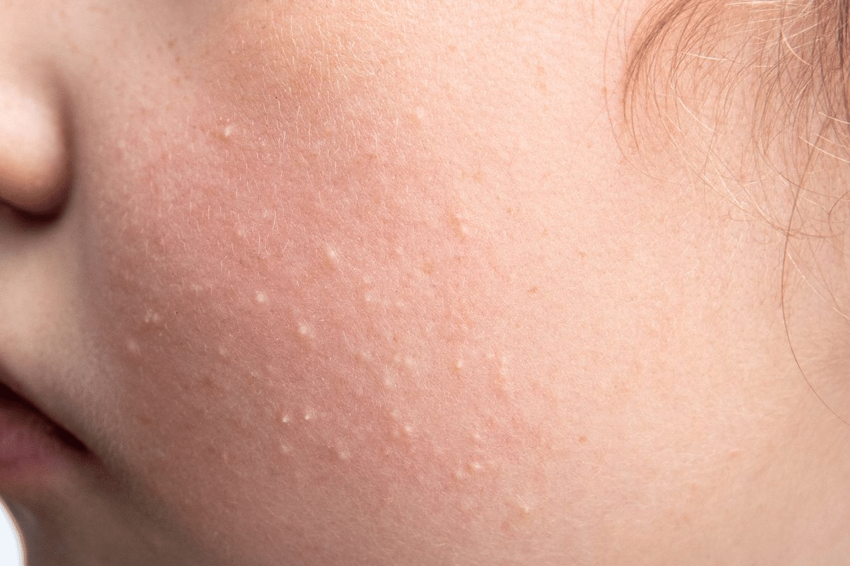 Sharp How To Get Rid Of Calcium Deposits In Toes - Liv Hospital