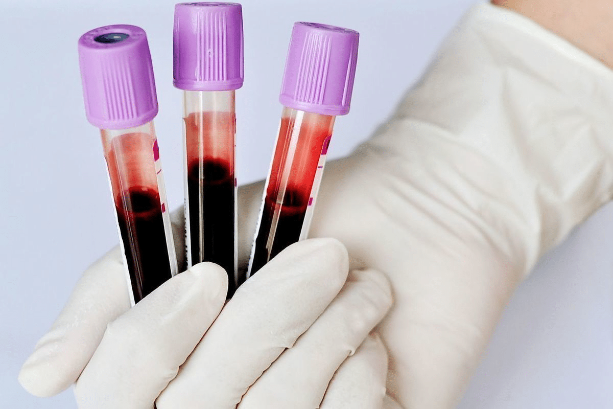Sharp Can Blood Work For Arthritis Detect RA? - Liv Hospital