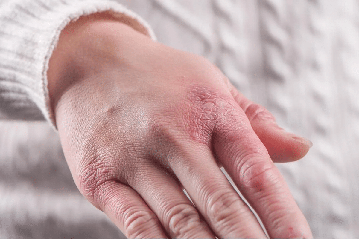 Valuable 7 Types Of Chronic Cutaneous Lupus Rashes - Liv Hospital