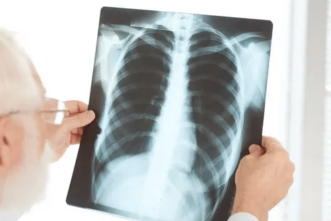 Simple CAP Pneumonia Definition & Diagnostic Criteria - Liv Hospital