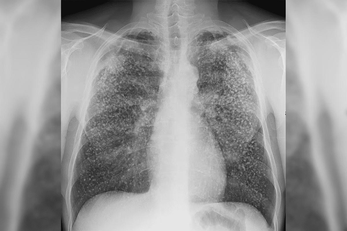 Simple CAP Pneumonia Definition & Diagnostic Criteria - Liv Hospital