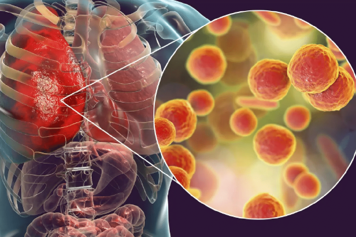 Key Community Acquired Pneumonia Types, Symptoms - Liv Hospital
