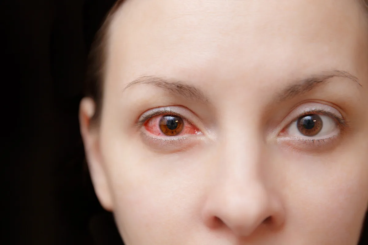 Why Is My Eye Red and Itchy? 7 Causes - Liv Hospital