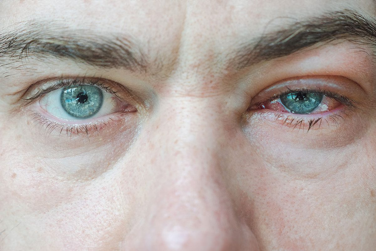 Valuable How To Stop Itchy Cat Allergy Eyes Quickly - Liv Hospital