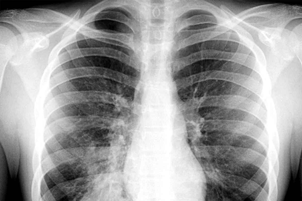 Ultimate How Long Is Bacterial Pneumonia Contagious? - Liv Hospital
