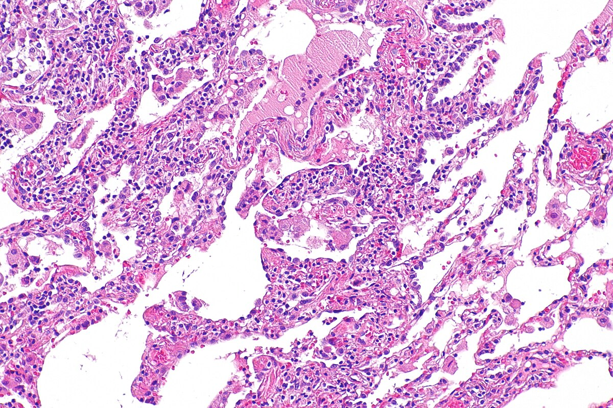 Acute Interstitial Pneumonia: Guide - Liv Hospital
