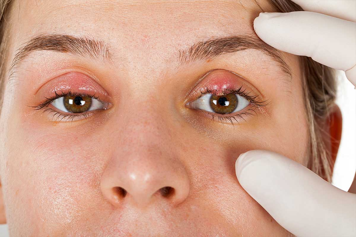 Eye Allergies Swelling: Fast Relief - Liv Hospital