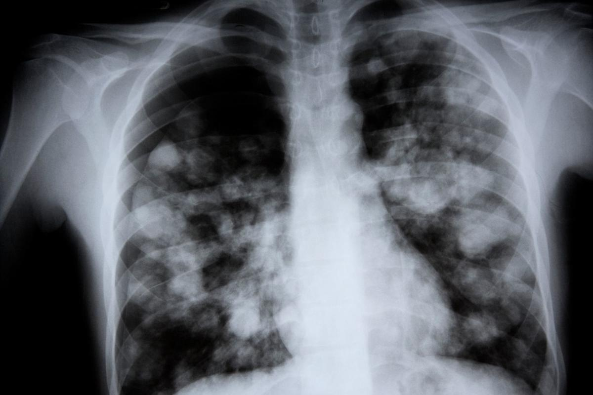 How Long Is Pneumonia Contagious? Vital Facts - Liv Hospital