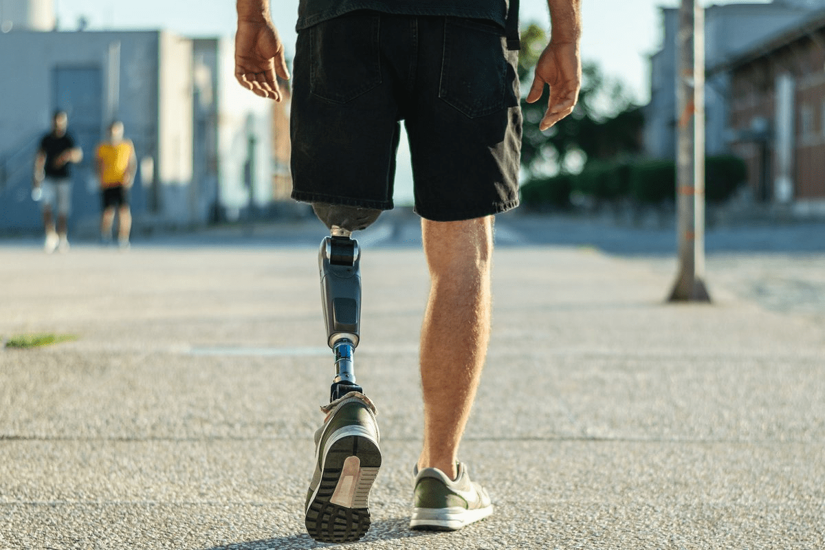 Amazing Prosthetic Leg For Above Knee Amputation: 5 Types - Liv Hospital