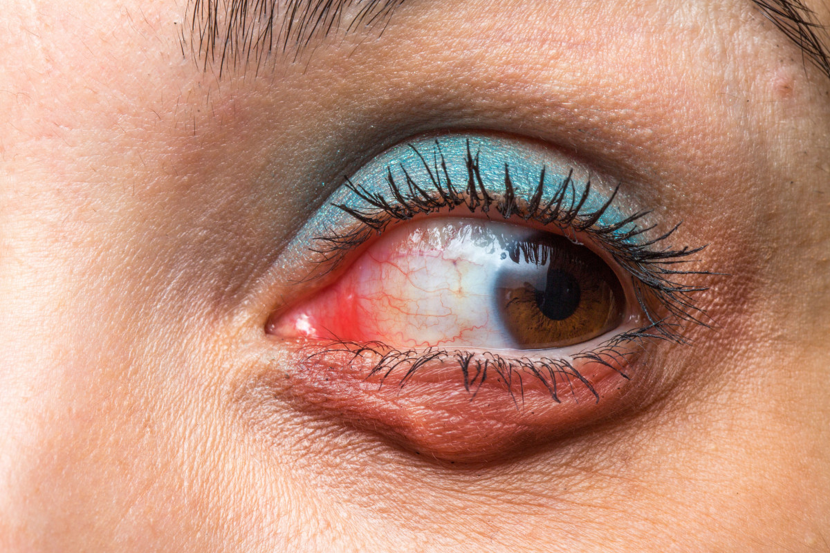 Fascinating How To Get Rid Of Blood Vessels In Eyes & Timeline - Liv ...