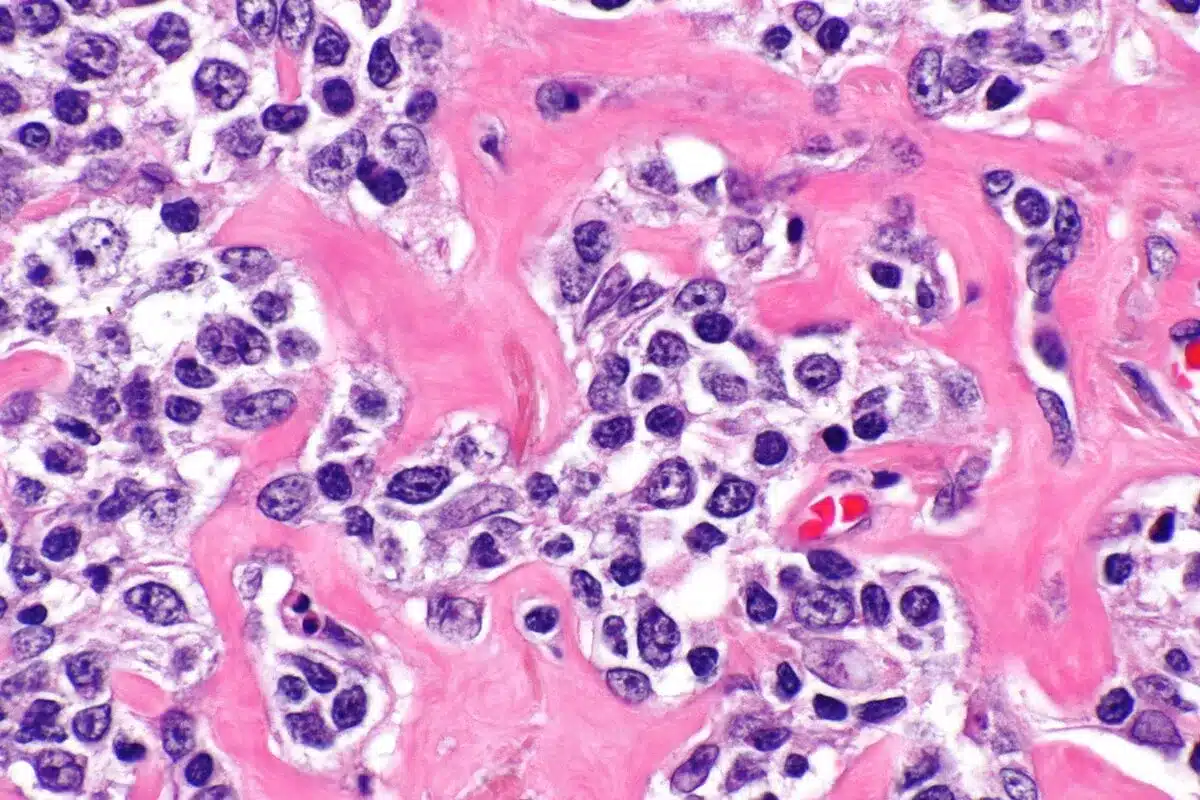 Lymph nodes in nose: Scary ultimate facts. - Liv Hospital